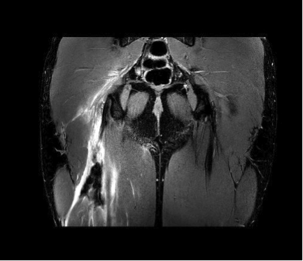 Sports Injury Bulletin - Diagnose & Treat - Intramuscular hamstring ...