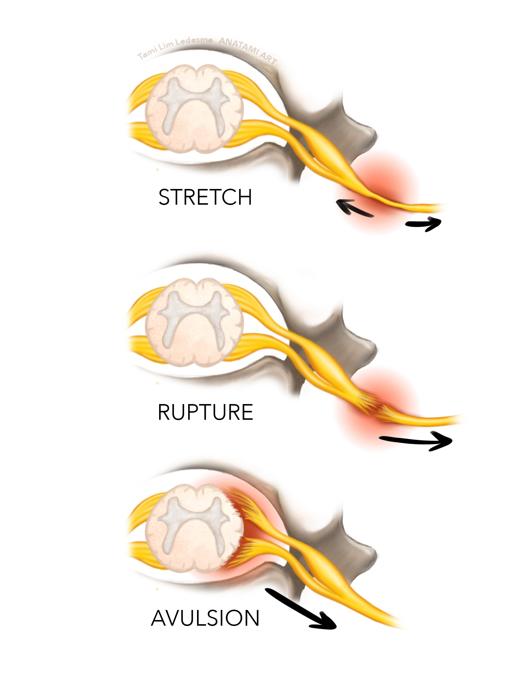 Sports Injury Bulletin - Diagnose & Treat - Brachial plexus injuries in ...