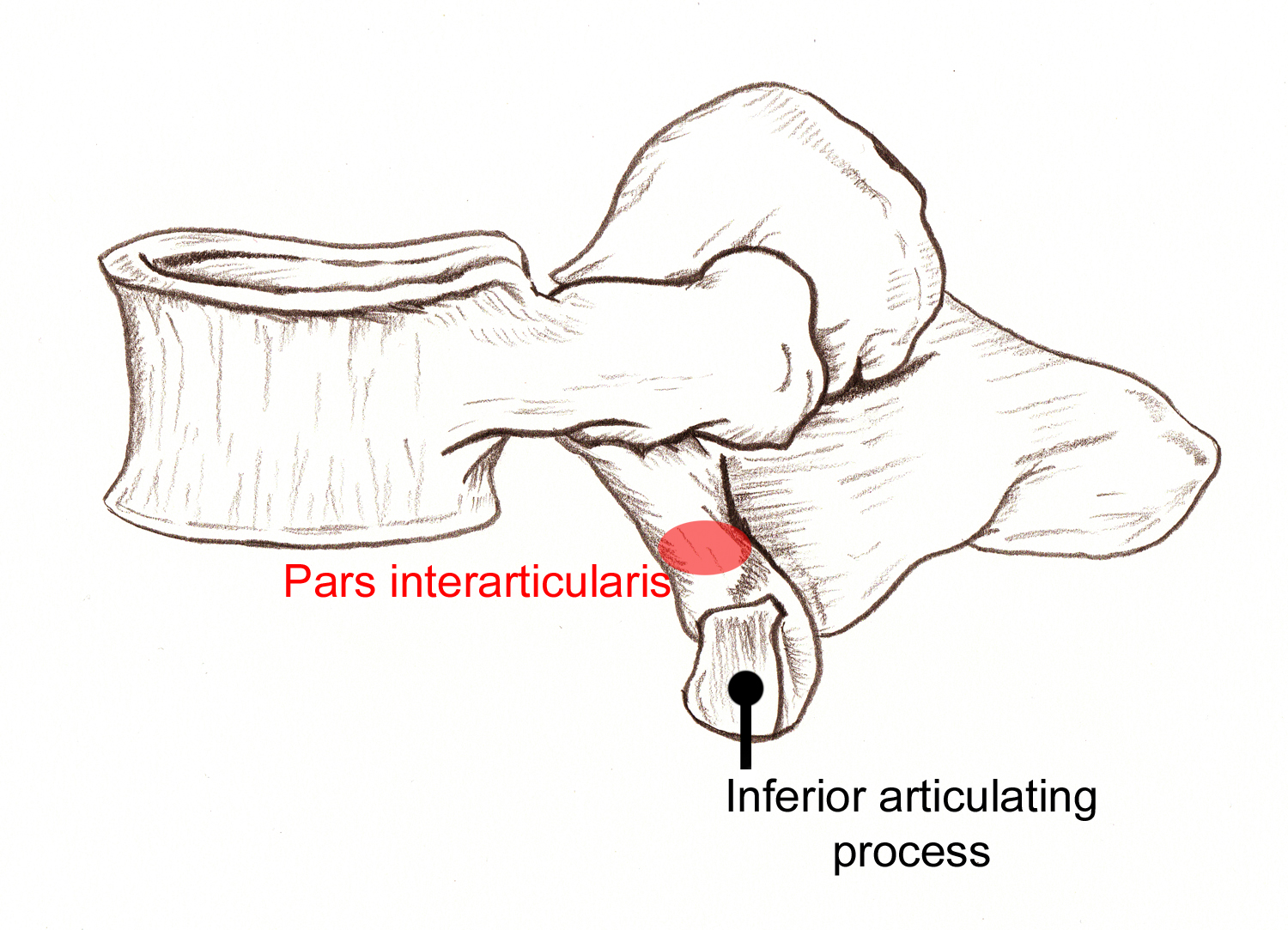 Sports Injury Bulletin - Diagnose & Treat - Lumbar spondylolysis in ...