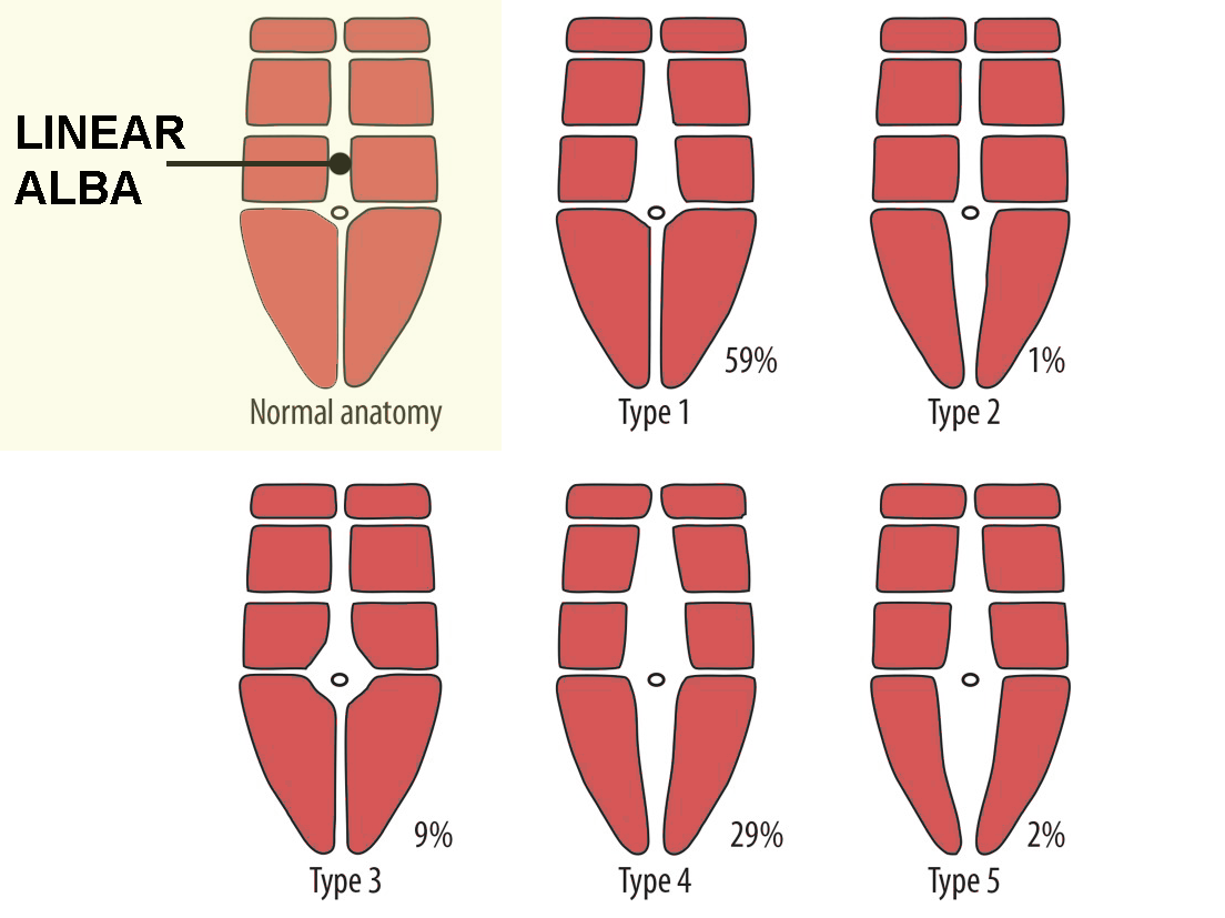 Sports Injury Bulletin - Anatomy - Mind the gap: Diastasis recti in ...