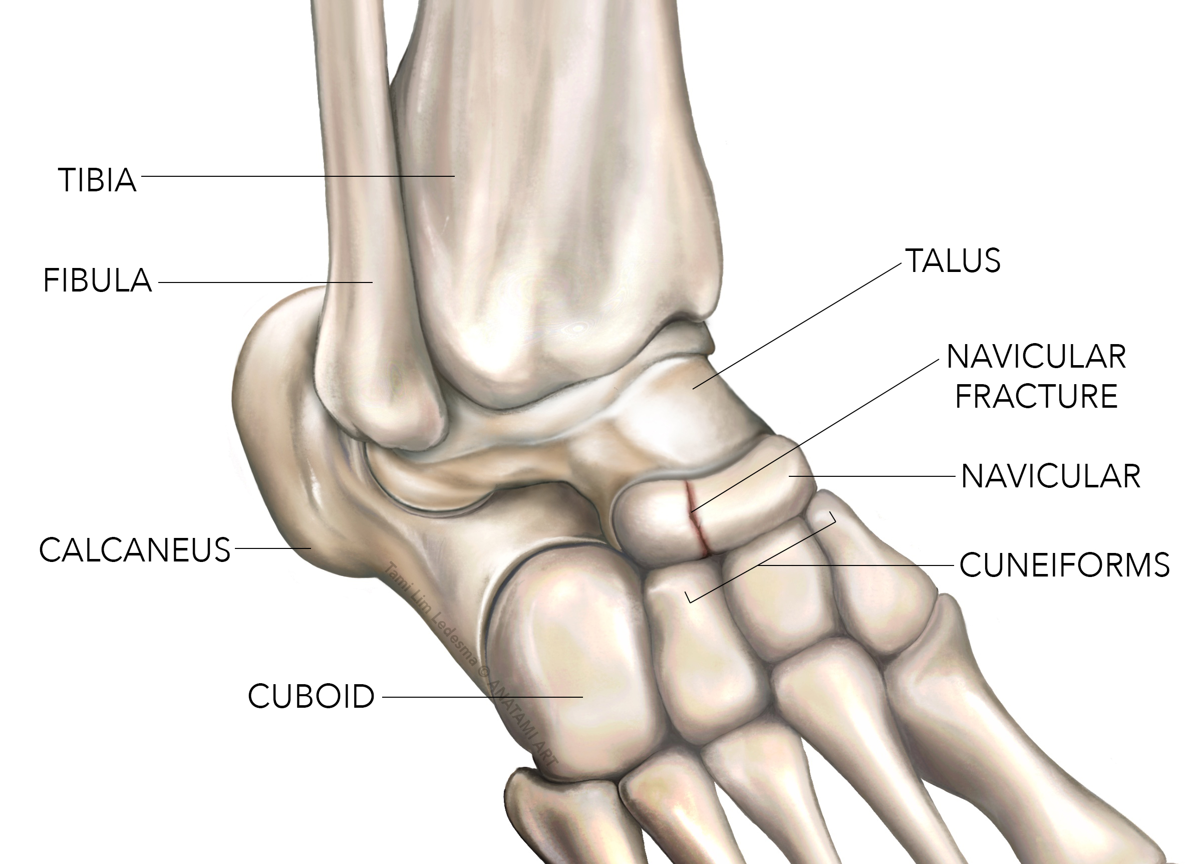 Navicular Stress Fracture Top Of Foot