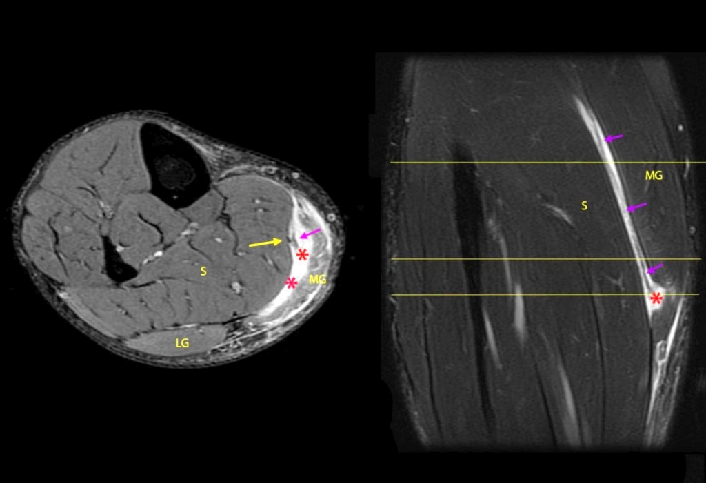 Sports Performance Bulletin - Muscles and tendons - Calf strain: what ...