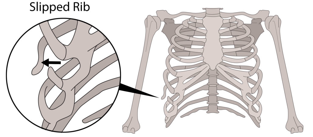 Sports Performance Bulletin - Injuries & health - Rib injuries in ...