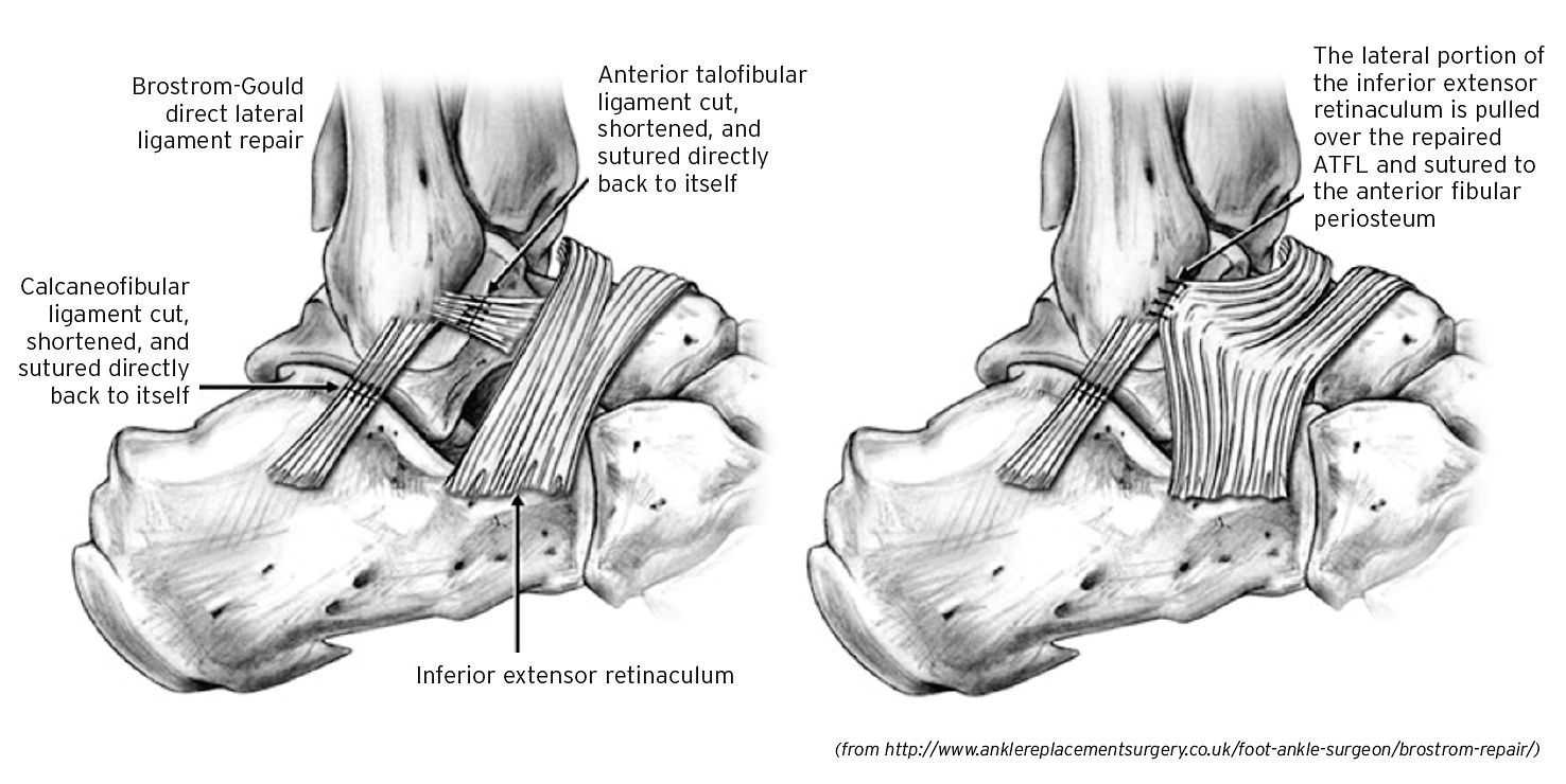 Sports Injury Bulletin - Anatomy - Masterclass on Ankle injury: Part II ...