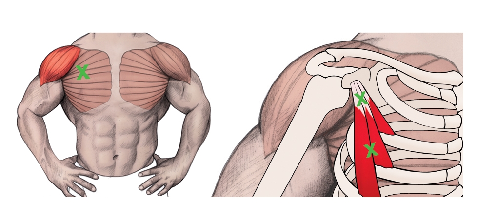 Sports Injury Bulletin - Diagnose & Treat - Pectoralis Minor