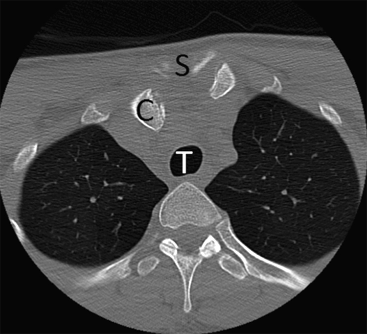 Sports Injury Bulletin - Diagnose & Treat - Sternoclavicular joint ...