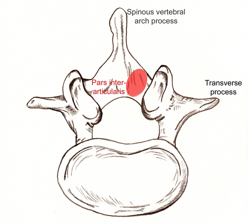 Sports Injury Bulletin - Diagnose & Treat - Lumbar spondylolysis in ...