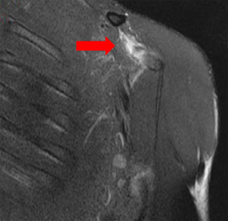 Sports Injury Bulletin - Diagnose & Treat - Uncommon injuries: Pec ...