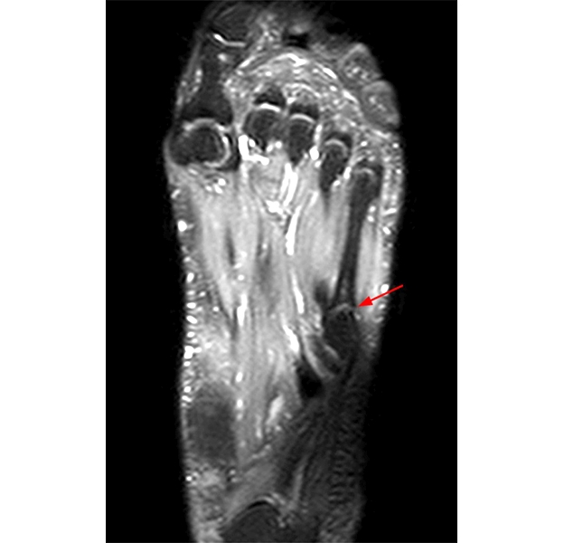 Sports Injury Bulletin - Anatomy - Fractures of the Proximal 5th ...