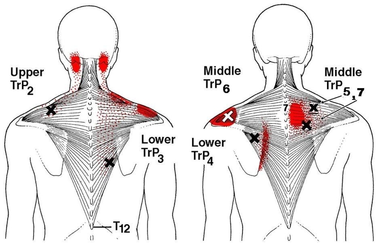 Sports Injury Bulletin - Diagnose & Treat - Upper trapezius: the key to ...
