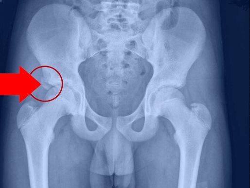 Sports Injury Bulletin - Diagnose & Treat - Hip avulsion injuries ...