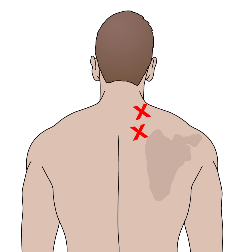 Sports Injury Bulletin - Improve - Levator scapulae: why length matters