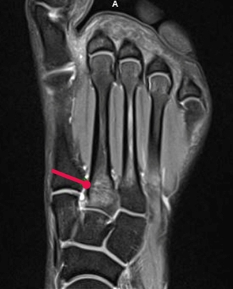 Sports Injury Bulletin - Anatomy - Case in point: Second metatarsal ...