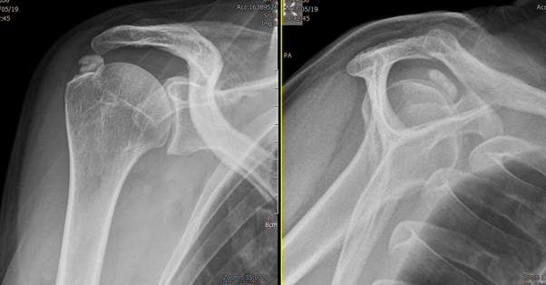 Sports Injury Bulletin - Anatomy - Calcific Tendonitis of the Shoulder